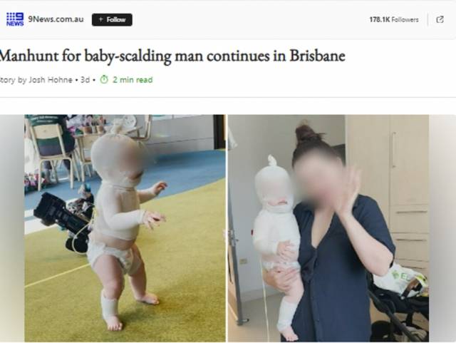 9개월 아기에 ‘뜨거운 커피 붓고 도주 화상 치료 중