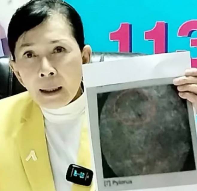 18년간 아래에서 통증” 결국 질에서 ‘이것 발견된 女 무슨 일