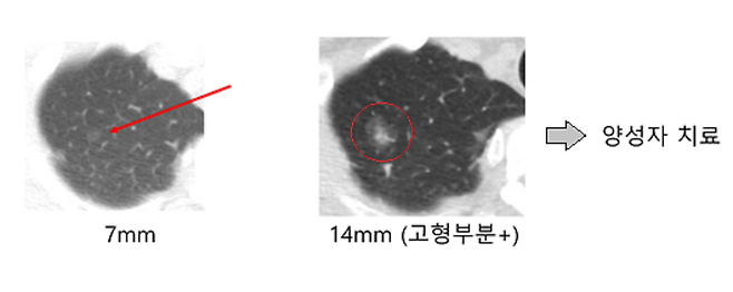 폐에서 뿌옇게 보이는 흔적 ‘간유리음영 결절 10년 지나도 뒤늦게 자란다