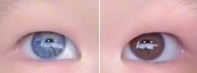 7세 소녀 눈동자 검정·파랑 색깔 달라무슨 질환이길래