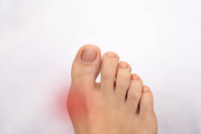통풍에 좋은 음식 통풍 환자가 주의할 겨울 습관 헬스라이프헤럴드