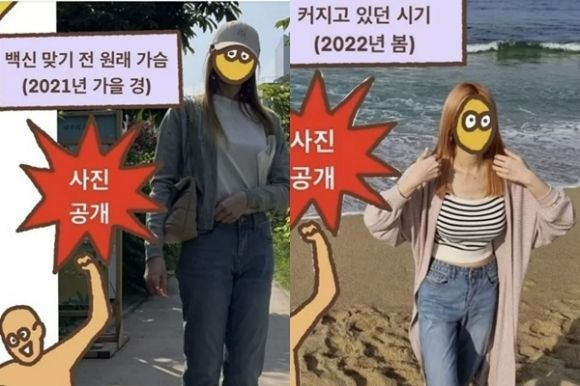 A컵→h컵 가슴 커지는 부작용 불러온 코로나 백신