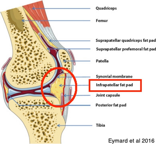 슬개골 아래쪽 통증 - 슬개하지방체염 (Hoffa fat pad syndrome; Infrapatellar fat pad ...