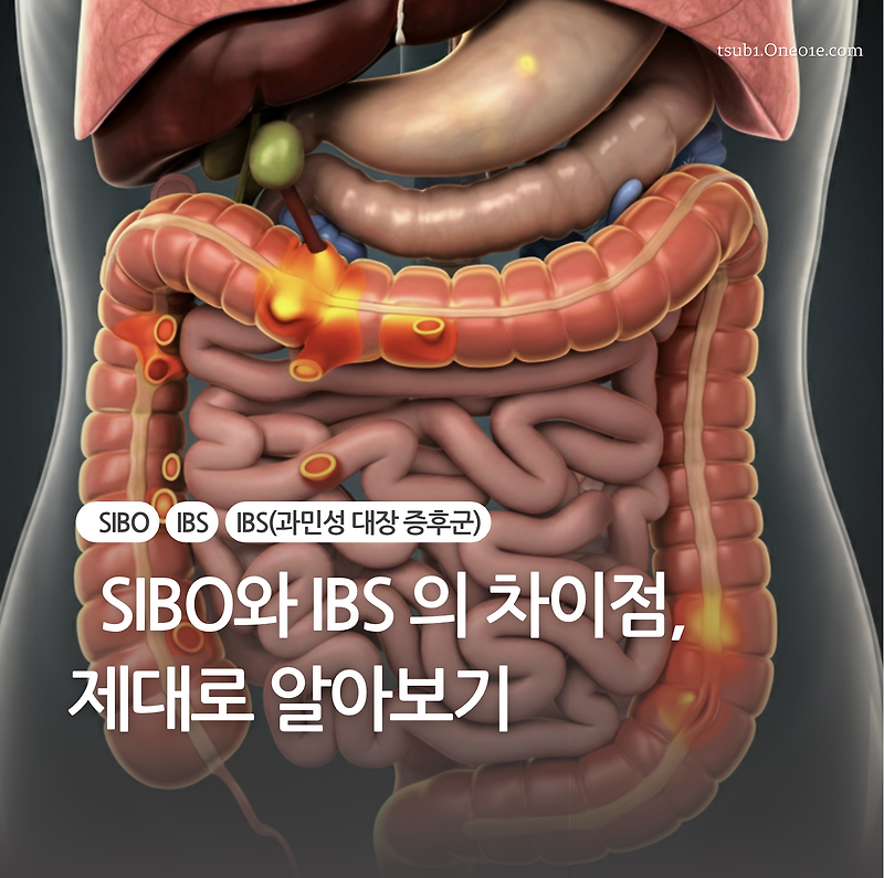 SIBO와 IBS(과민성 대장 증후군)의 차이점, 제대로 알아보기
