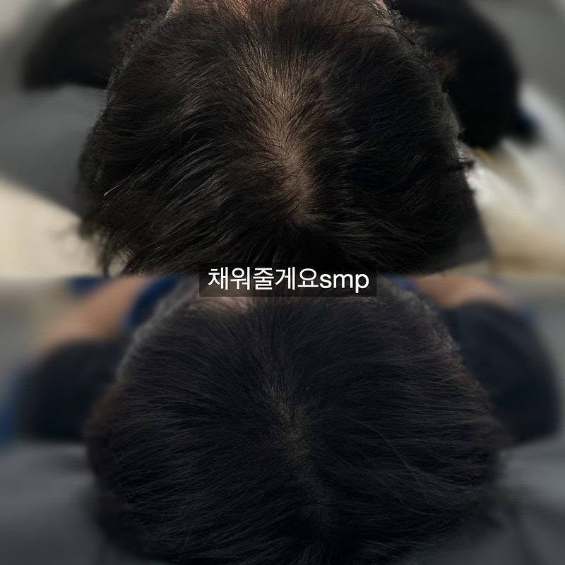 광주두피문신 정수리 탈모 완벽 극복! 채워줄게요smp