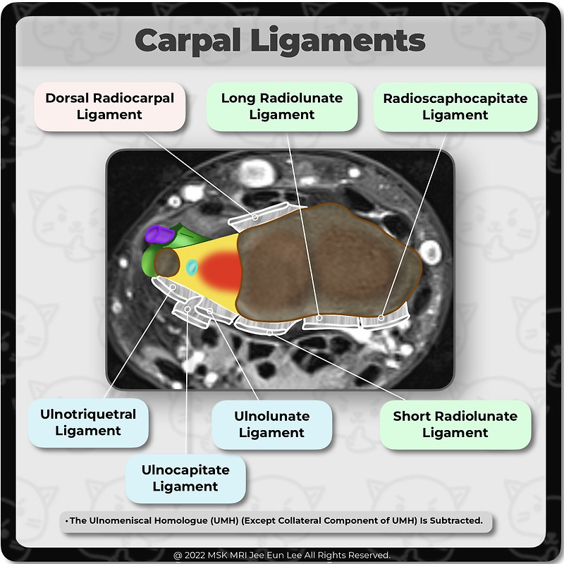 [Anatomy_24] Carpal Ligaments, Triangular fibrocartilage complex (TFCC ...