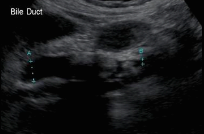 담도폐쇄의 원인 (causes of biliary obstruction) :: ultrasound study