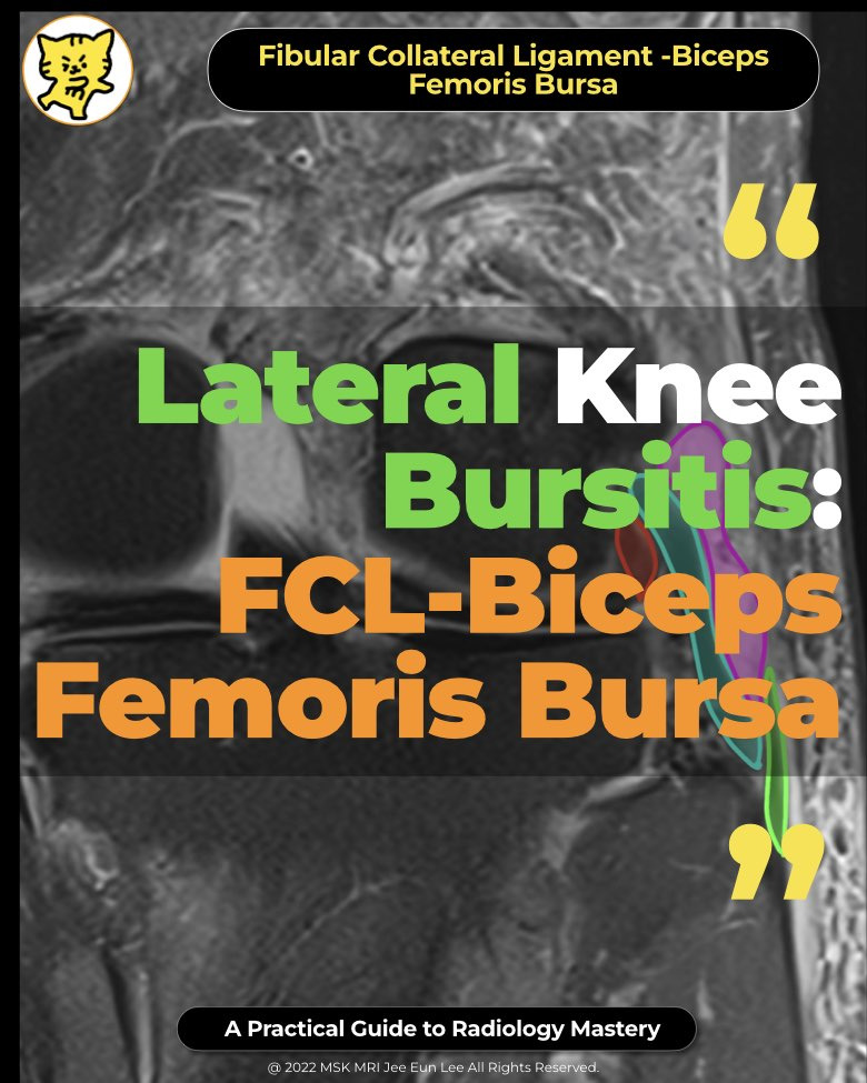 Lateral Knee Bursitis: FCL-Biceps Femoris Bursa