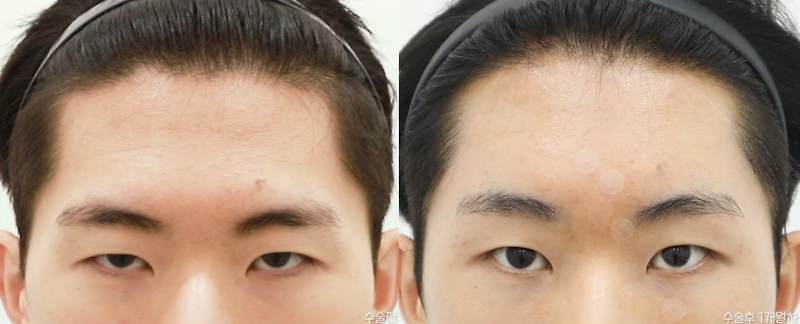 Korean Male Forehead Lift (Pre-Surgery/Post-Surgery 1 Month - Recovery ...