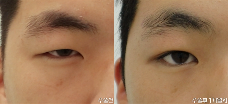 Korean Male Forehead Lift, Non-Incisional Ptosis Correction (Before/1 ...