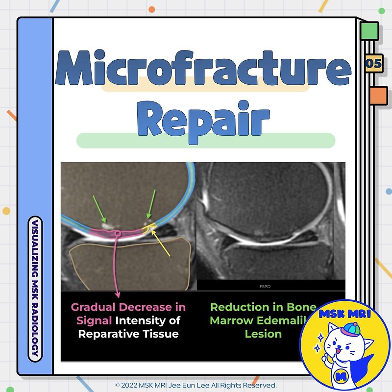 (Fig 5-C.05) MRI Findings of Microfracture Repair