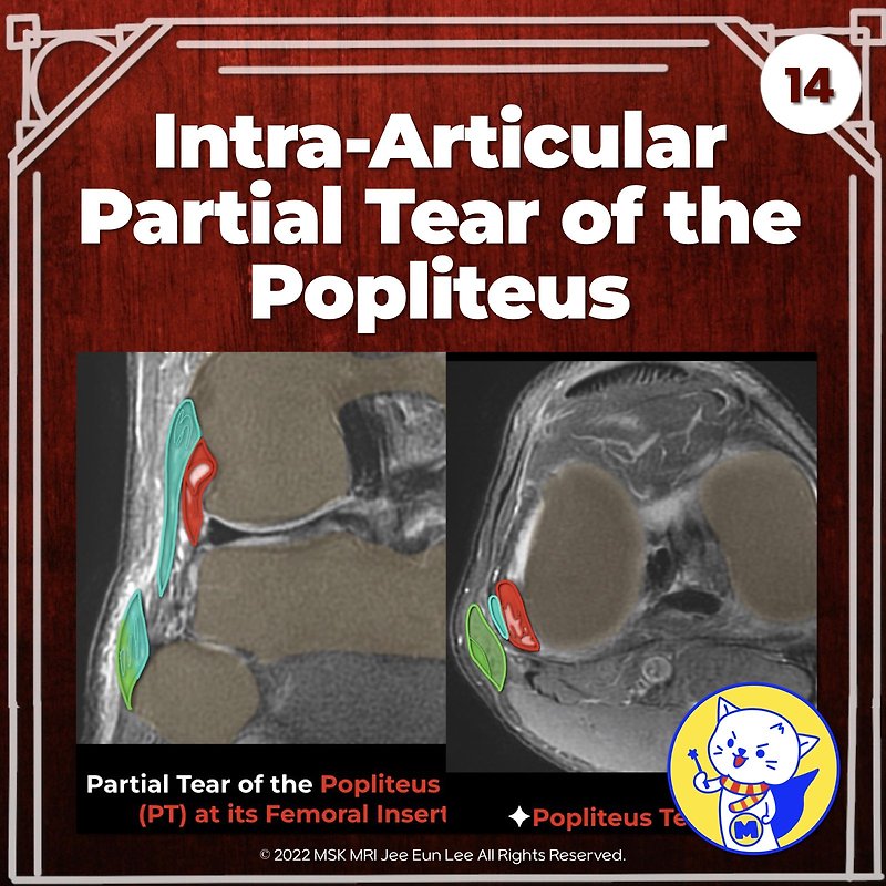 (Fig 3-B.14) Intra-Articular Partial Tear of the Popliteus