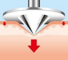 SSP(silver spike point) 요법