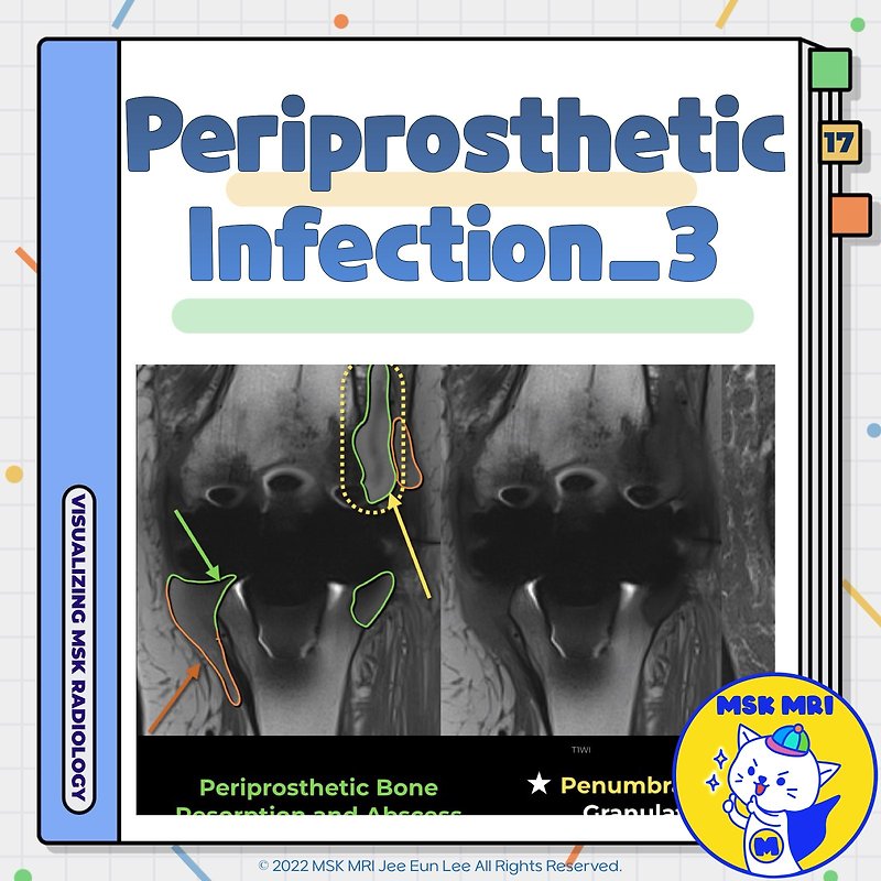 (Fig 5-D.17) Periprosthetic Infection - Abscess