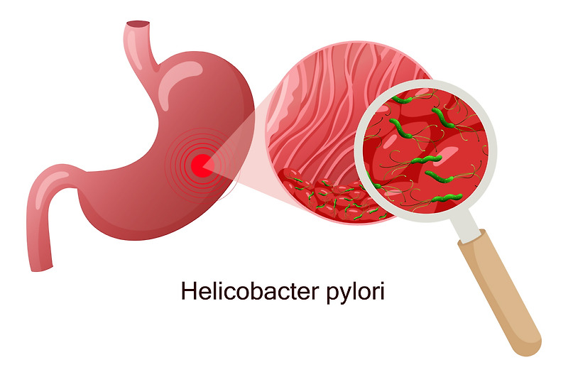 헬리코박터 파일로리(helicobacter pylori infection)/ 헬리코박터균 역사, 원인, 증상, 진단방법, 제균치료