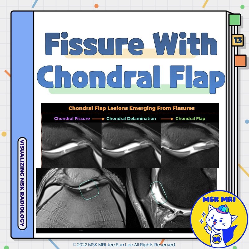 (Fig 5-A.13) Fissure with Chondral Flap