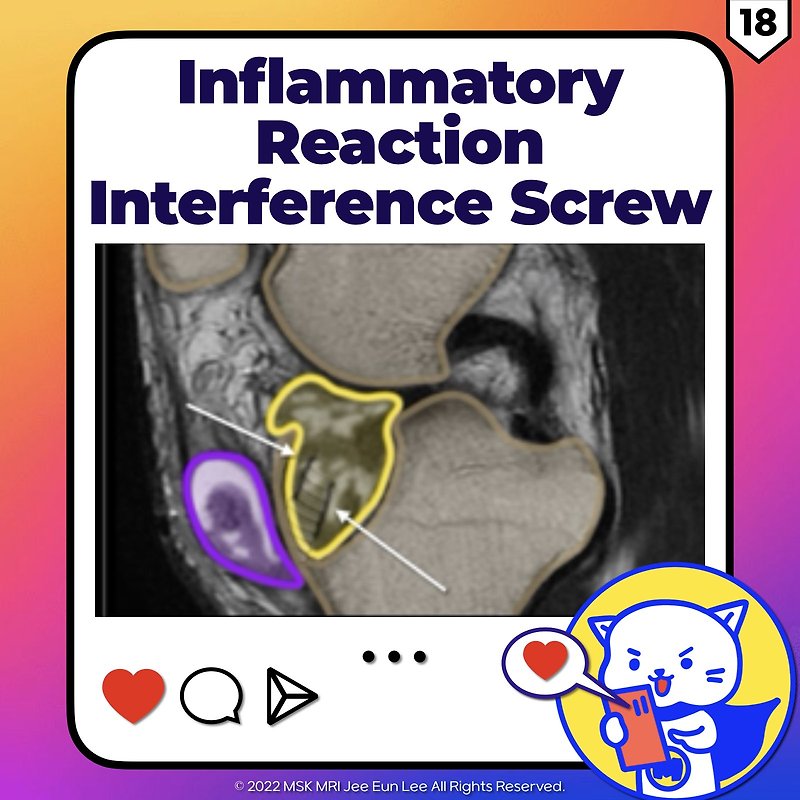 (Fig 2-D.18) Inflammatory Reaction of the Bioabsorbable Interference ...
