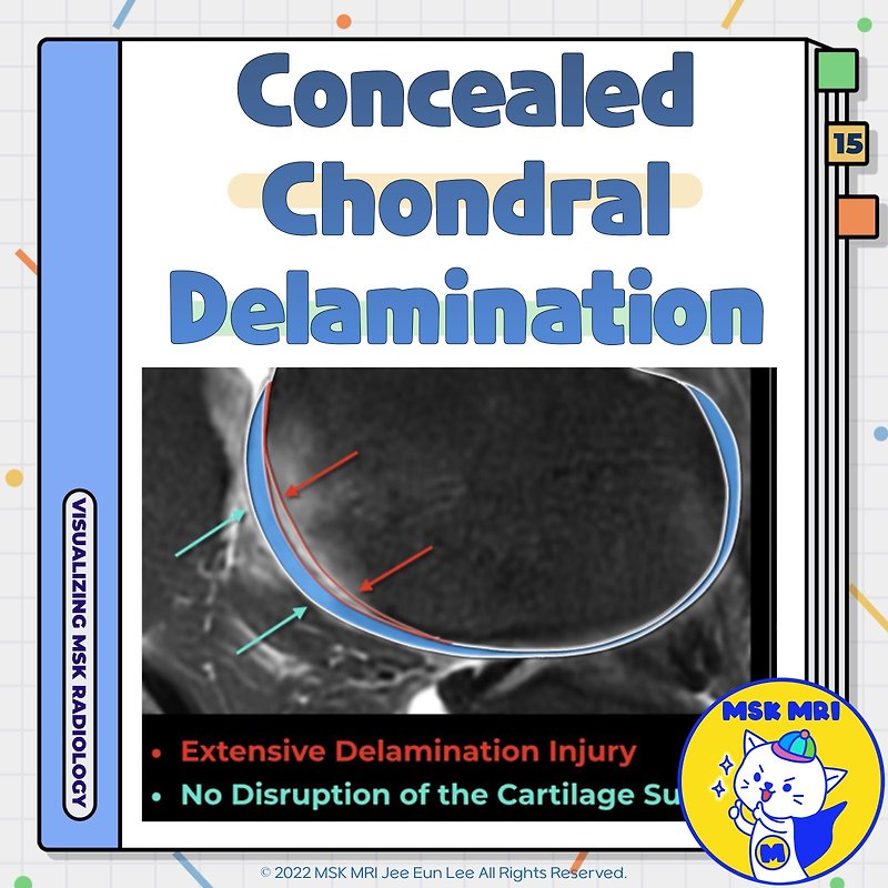 (Fig 5-A.15) Concealed Chondral Delamination