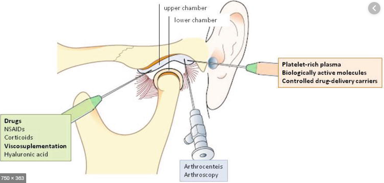 TM joint injection을 위한 anatomy 악관절 TMJ