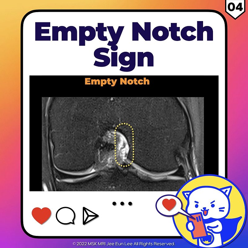 (Fig 2-B.04) Empty notch sign