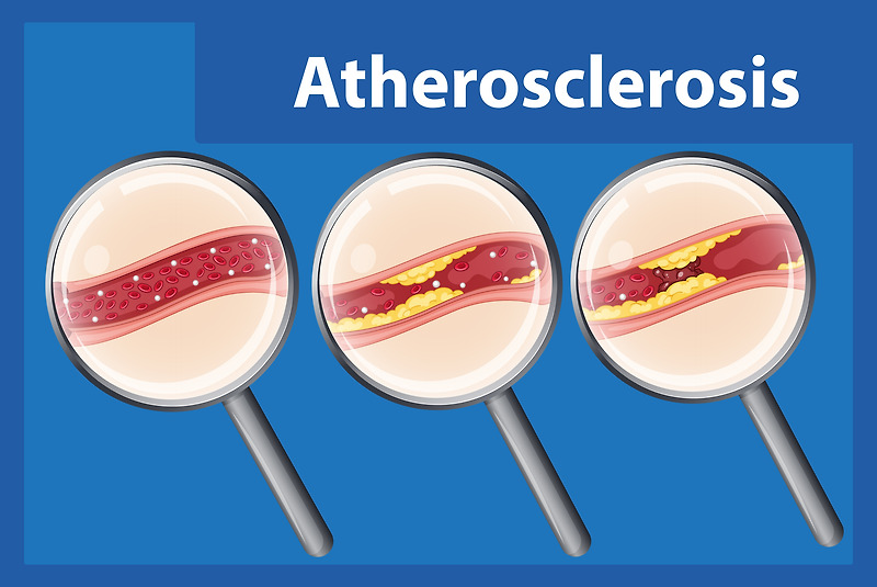 동맥경화증(動脈硬化症, Atherosclerosis, Arteriosclerosis)::예당한의원 - 약식동원의 시작