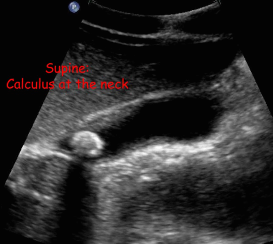 담낭 질환 (gallbladder disease) - 담석증(GB stone), 담낭용종(polyp) :: ultrasound ...