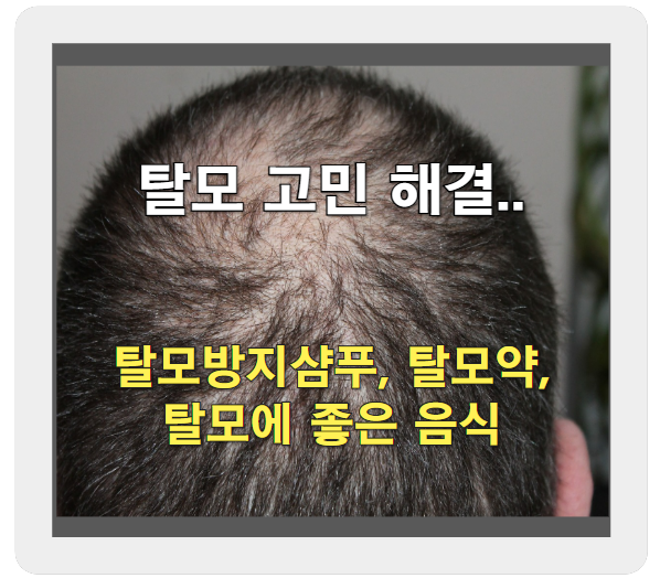탈모 고민 해결, 탈모샴푸부터 탈모에 좋은 음식, 그리고 탈모약