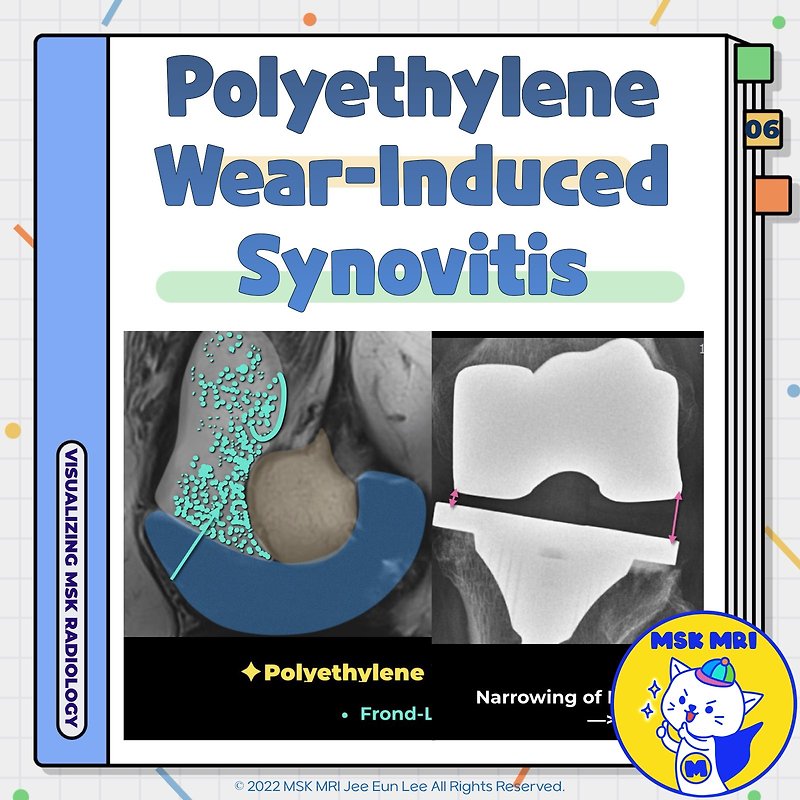 (Fig 5-D.06) Polyethylene Wear–Induced Synovitis