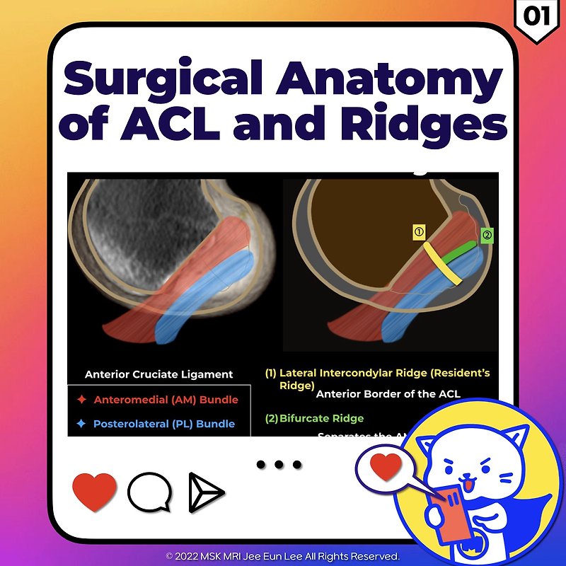 (Fig 2-A.01) Surgical Anatomy of ACL and Associated Ridges