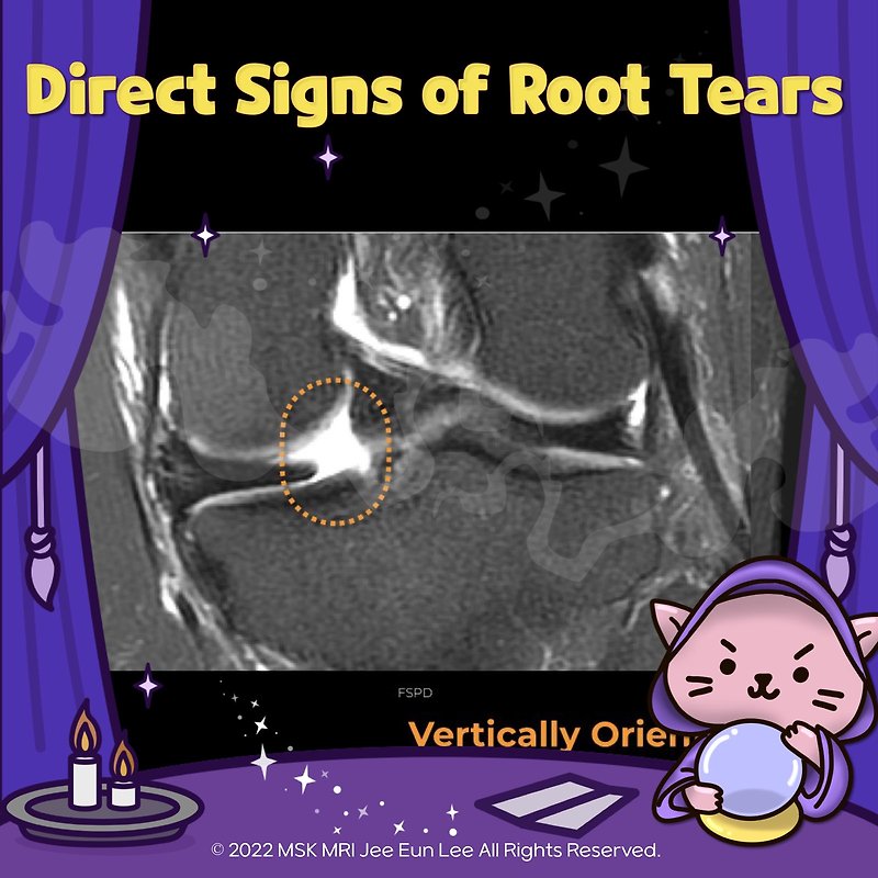 (Fig 1-B.26) Direct signs of root tears
