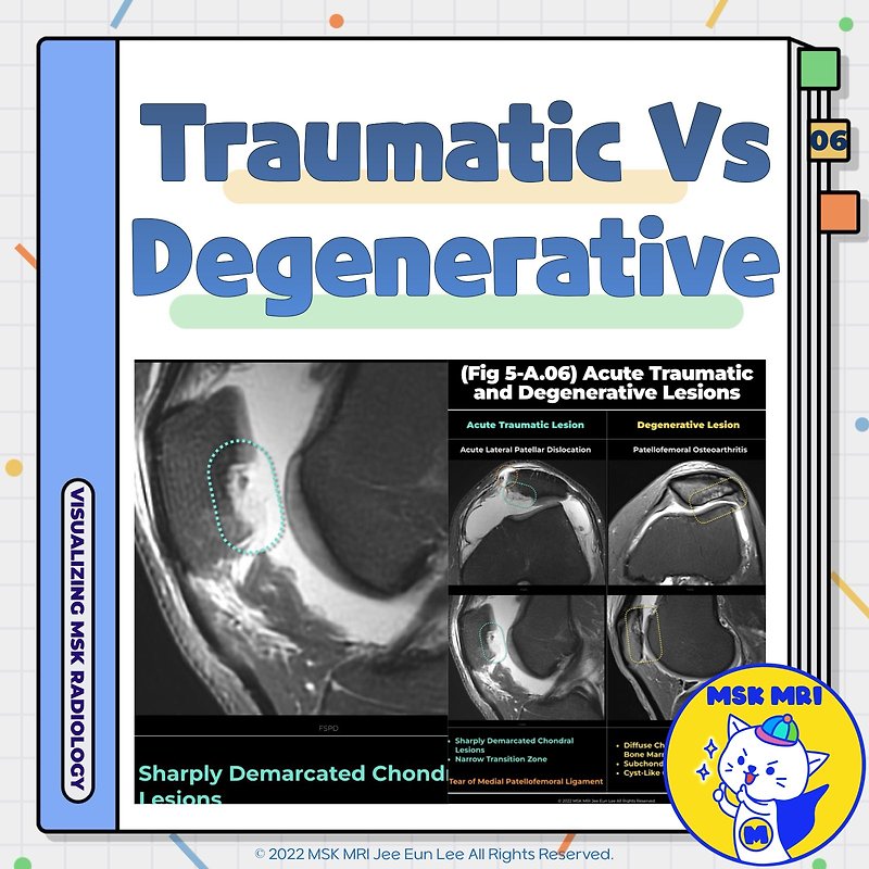 (Fig 5-B.06) Causes of Osteochondral Defect