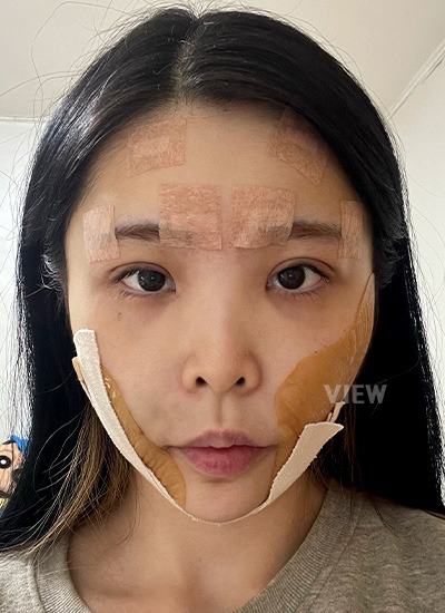 Double eyelid, Thread lift, Fat graft Review - Plastic surgery journey ...