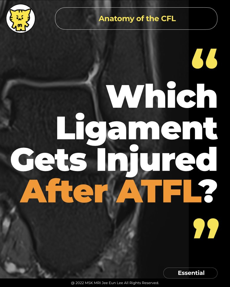 [Essential] Comprehensive Guide to Calcaneofibular Ligament (CFL ...