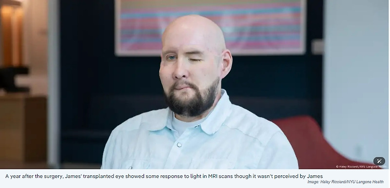 세계 최초의 얼굴, 눈 이식 성공 사례 World-first face, eye transplant a 'cautious ...