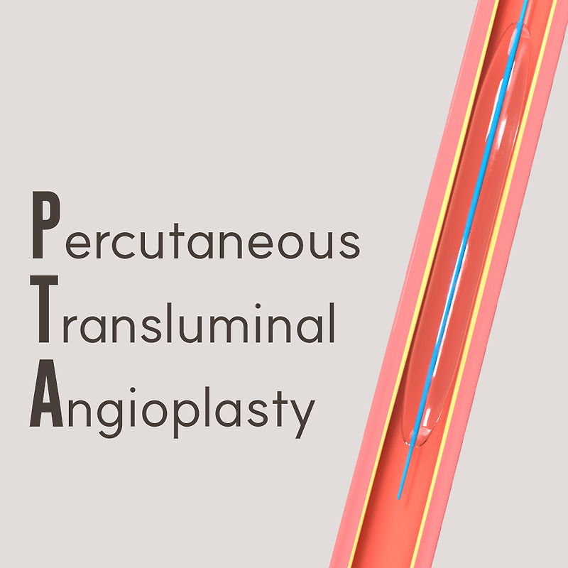 What is Percutaneous Transluminal Angioplasty (PTA)?