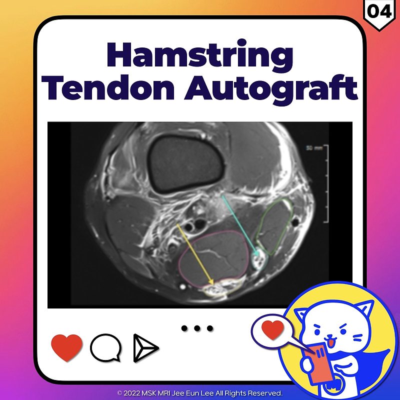 (Fig 2-C.04) Hamstring tendon (HT) autograft