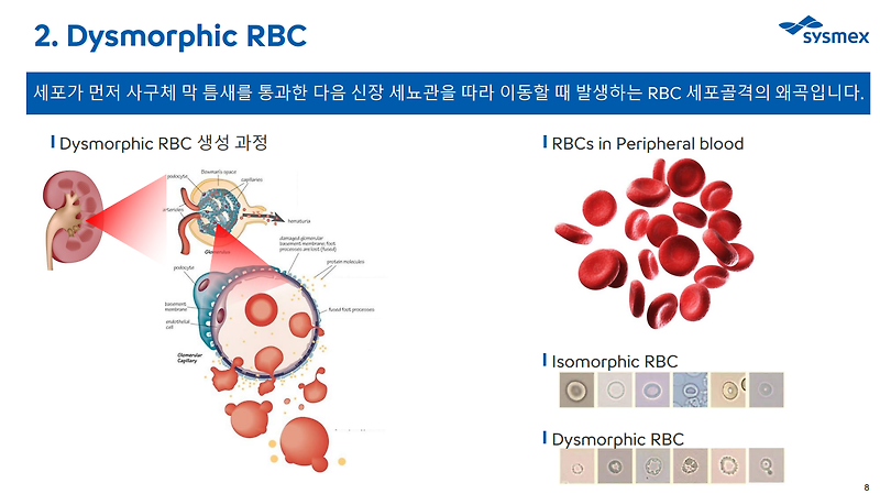 Dysmorphic RBC 검사는 가라! 자동화된 혈뇨 검사 urine RBC distribution 검사