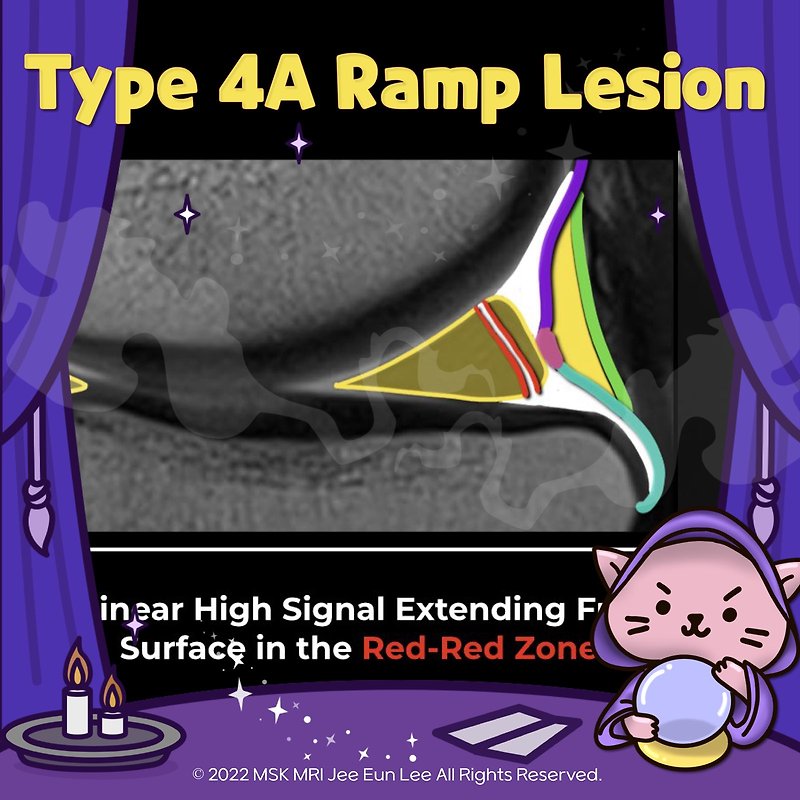 (Fig 1-B.39) Type 4A Ramp lesion