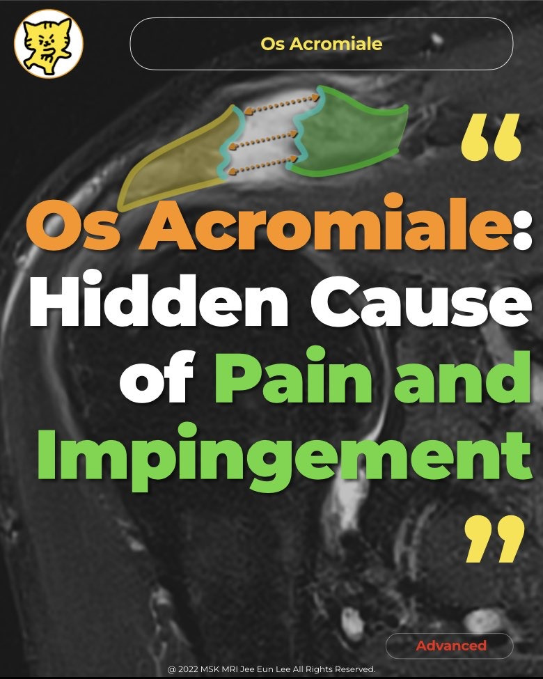 Os Acromiale: Hidden Cause of Shoulder Pain and Impingement