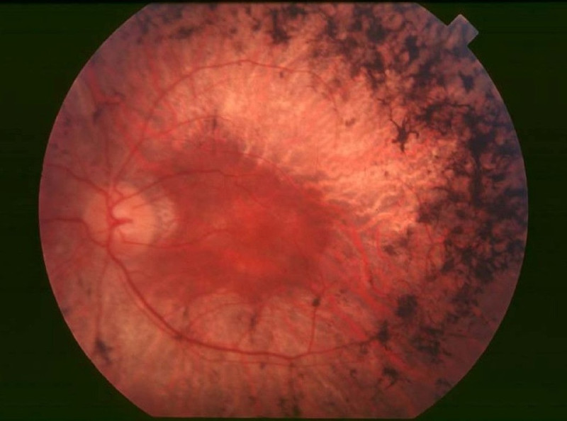 희귀 난치성 질환 '유전성 망막 질환(Inherited Retinal Dystrophy, IRD)' 망막색소변성증 환자분들은 이 ...
