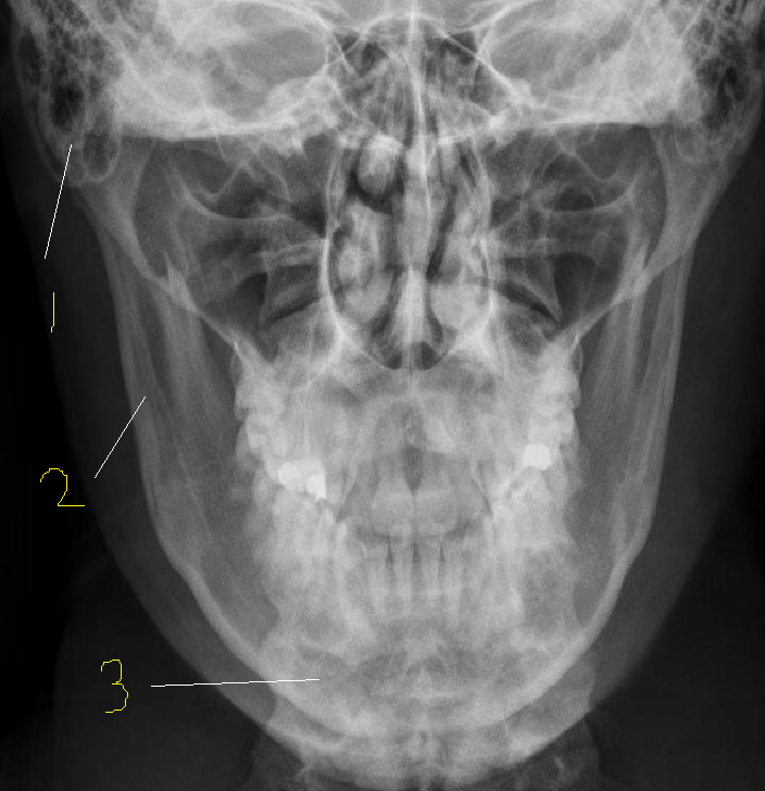 Mandible PA·PA axial,AP Axiolateral OBL/TM Joint Axiolateral