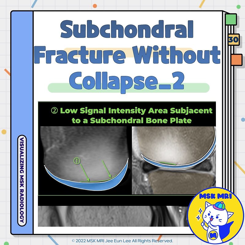 (Fig 5-B.30) Subchondral Fracture without Epiphyseal Collapse/ Part 2