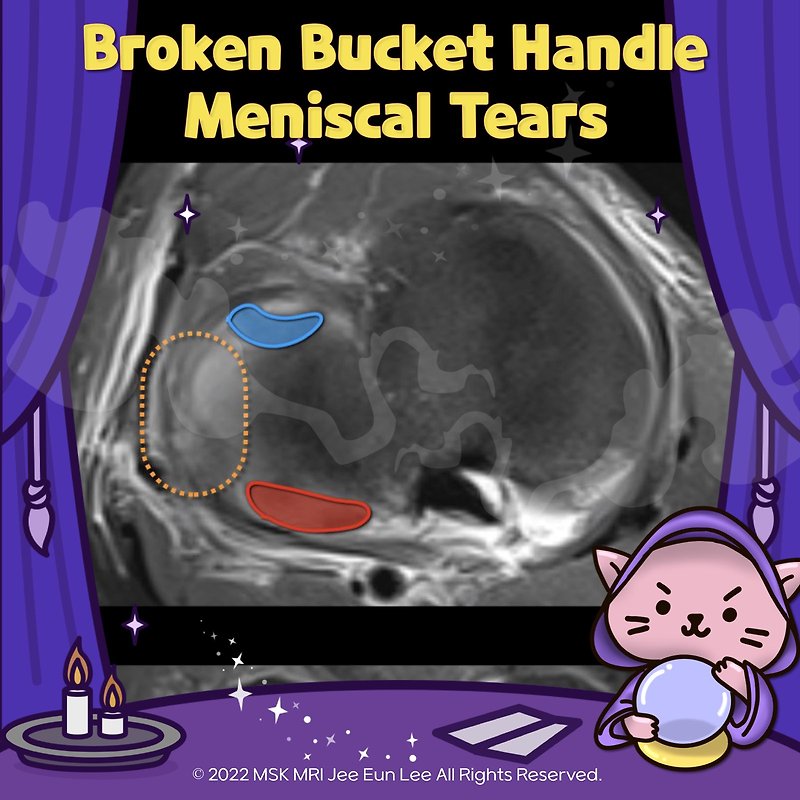 (Fig 1-B.23) Broken Bucket Handle Meniscal Tears