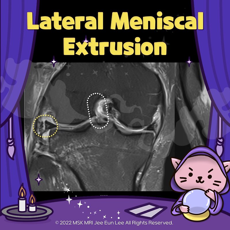 (Fig 1-C.15) Lateral Meniscal Extrusion