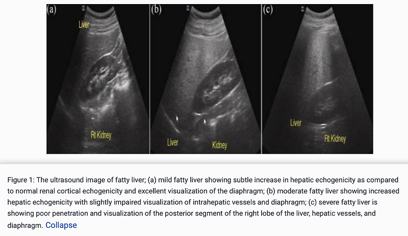 Diffuse liver disease - Fatty liver :: ultrasound study