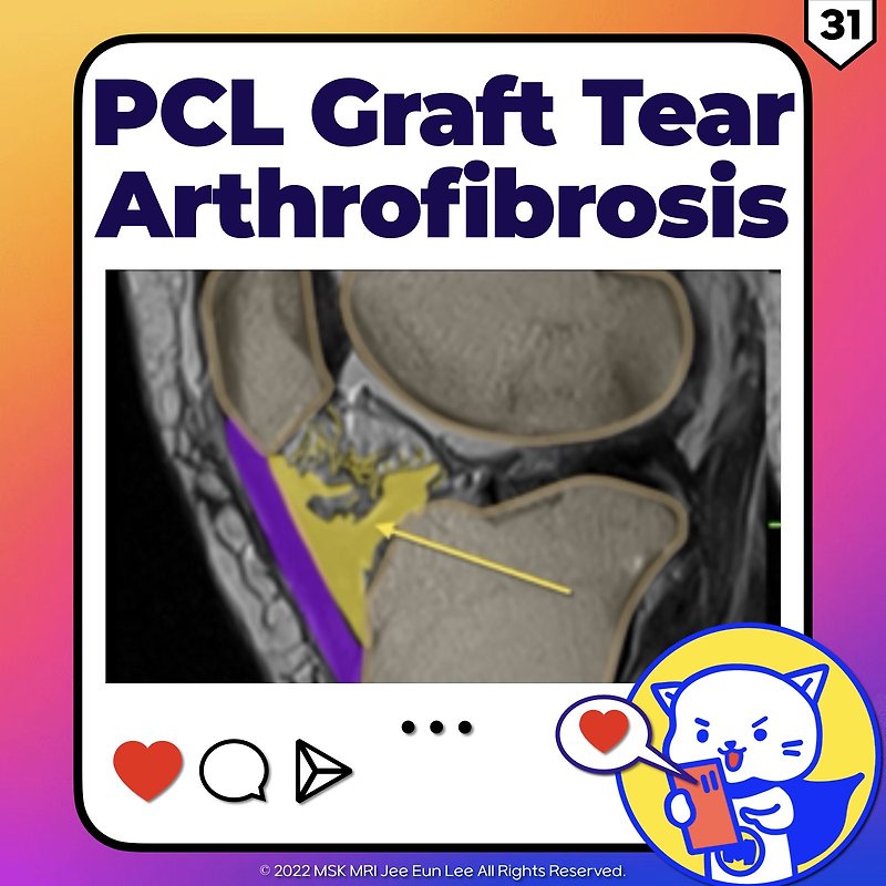 (Fig 2-E.31) Graft Tear In PCL Reconstruction and Arthrofibrosis