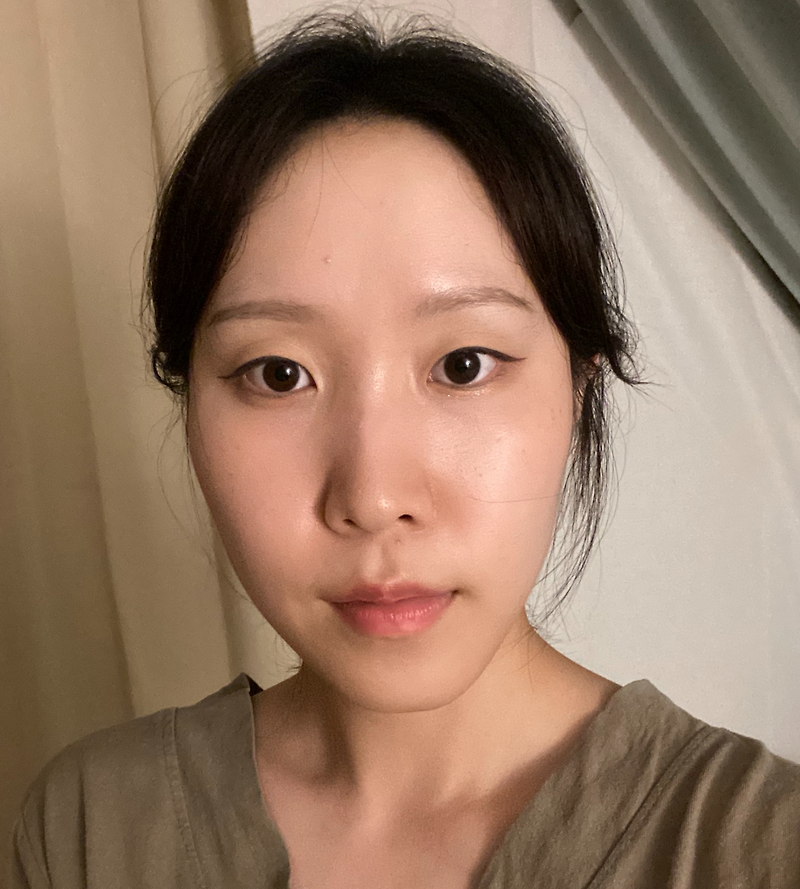 안면비대칭 수술 부작용 피해 '턱교정' 받은 결과