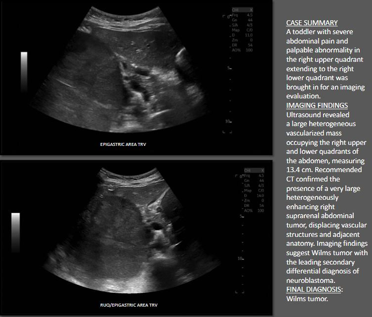 Wilms tumor /nephroblastoma