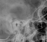 방사선사 국가고시(2교시) - 일반촬영(orbit , sella turcica)