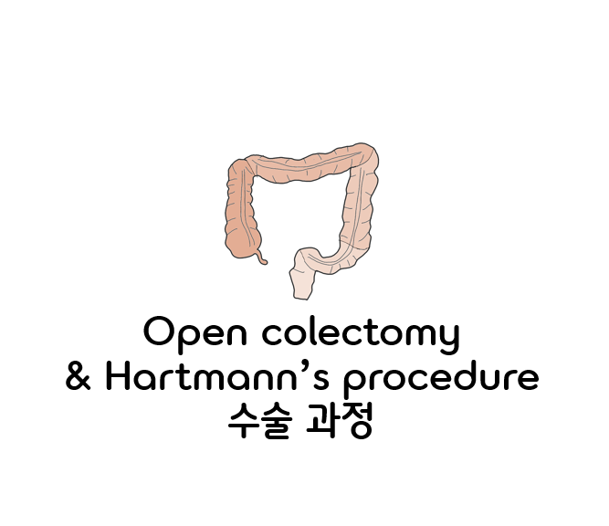GS / Open Colectomy & Hartmann’s procedure 수술과정